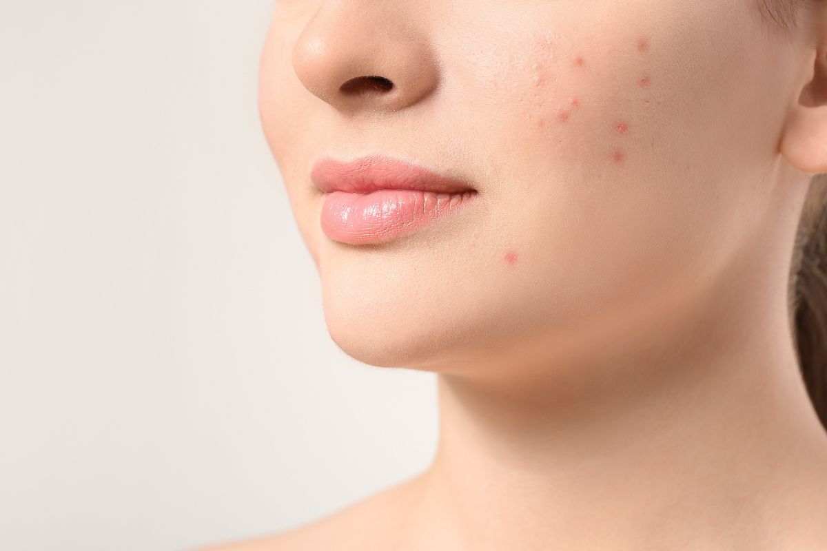 5 Common Skin Problems and their Treatments