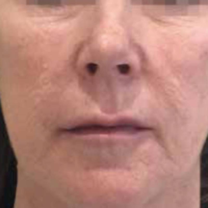 Profhilo Injections | Estheva Medical Aesthetic Clinic