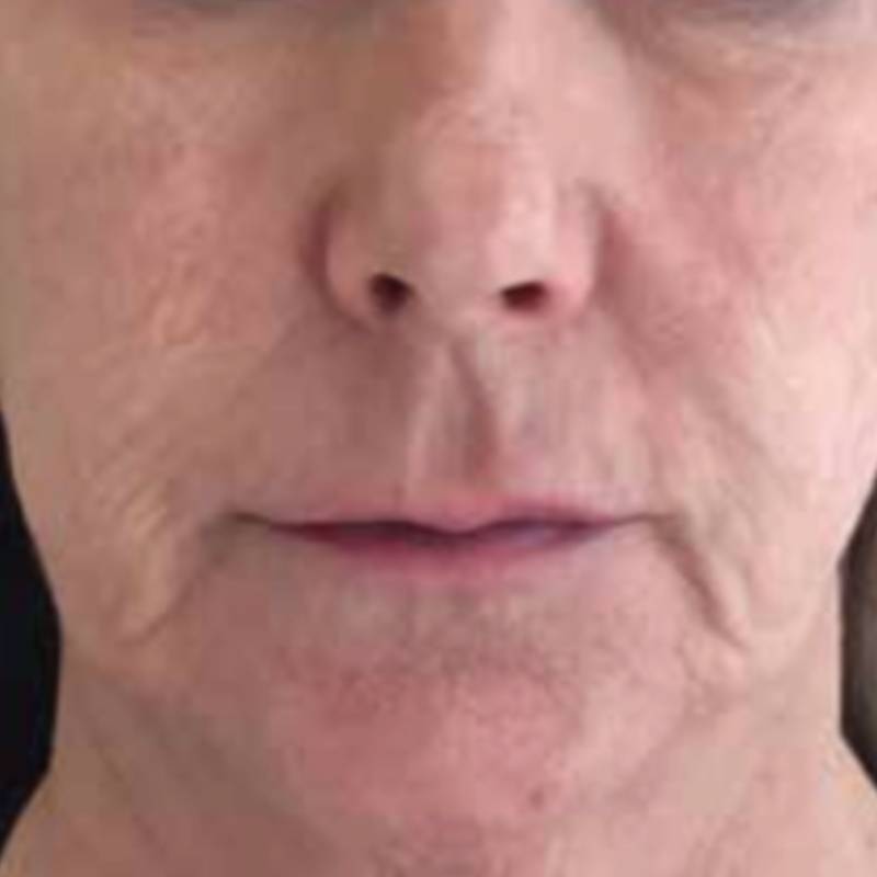 Profhilo Injections | Estheva Medical Aesthetic Clinic